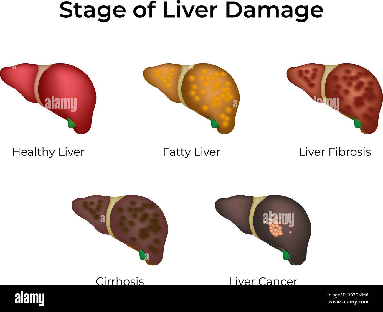 Then cirrhosis where the liver becomes severely scarred Cut Out Stock Images & Pictures - Alamy