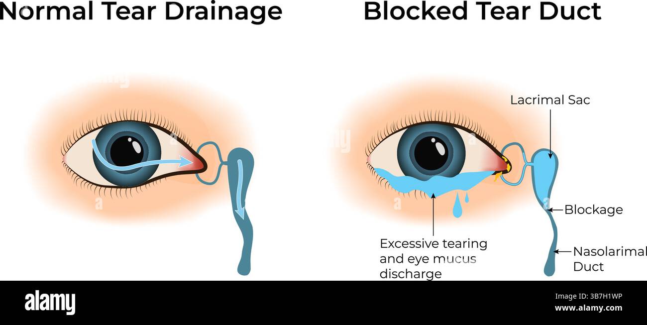 Normal tear drainage hi-res stock photography and images - Alamy