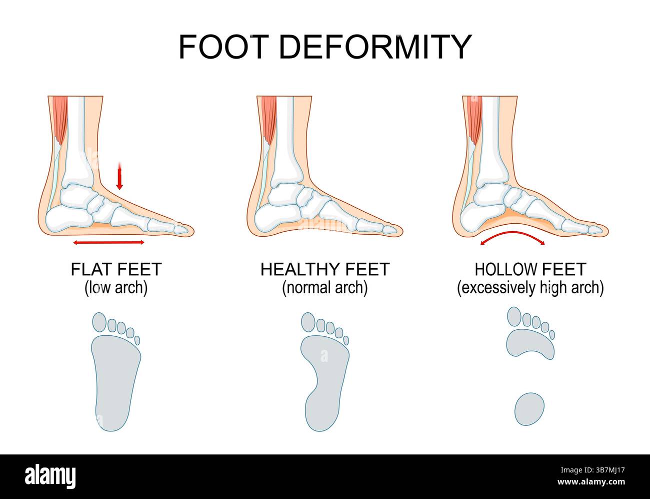 Foot deformity. Healthy feet with normal arch and footprint. Flat feet ...
