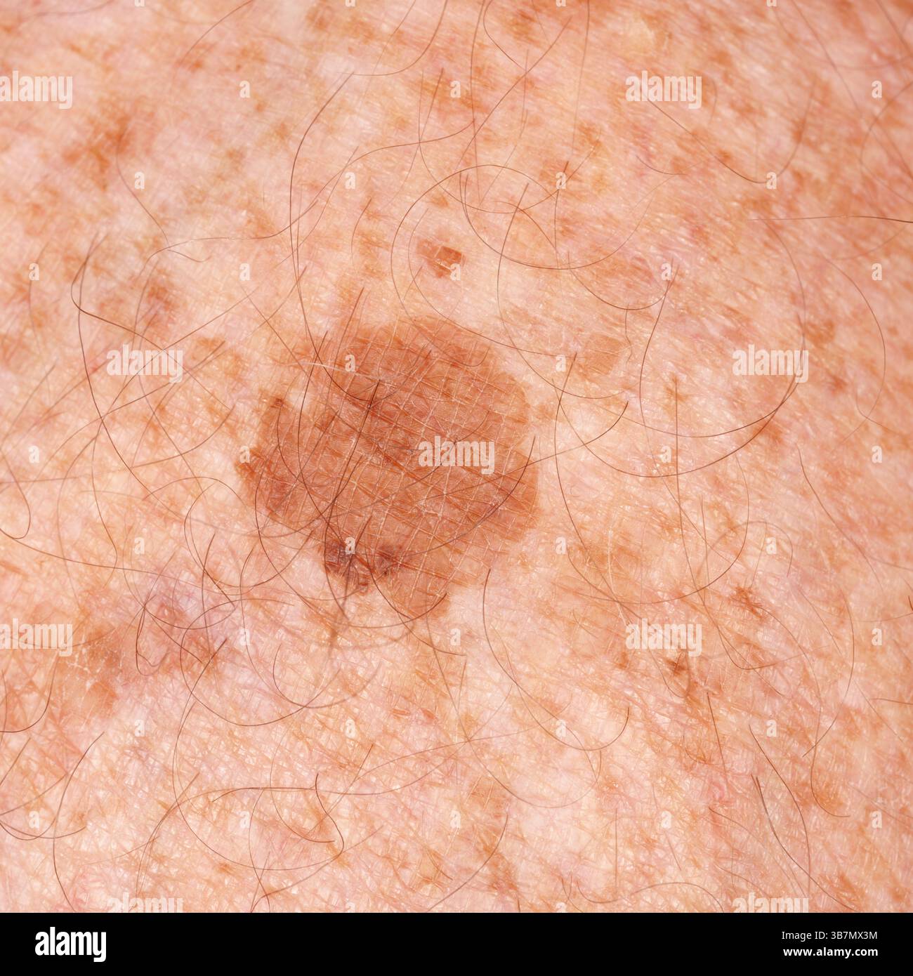 Freckles and large skin spots on leg of elderly man Stock Photo - Alamy