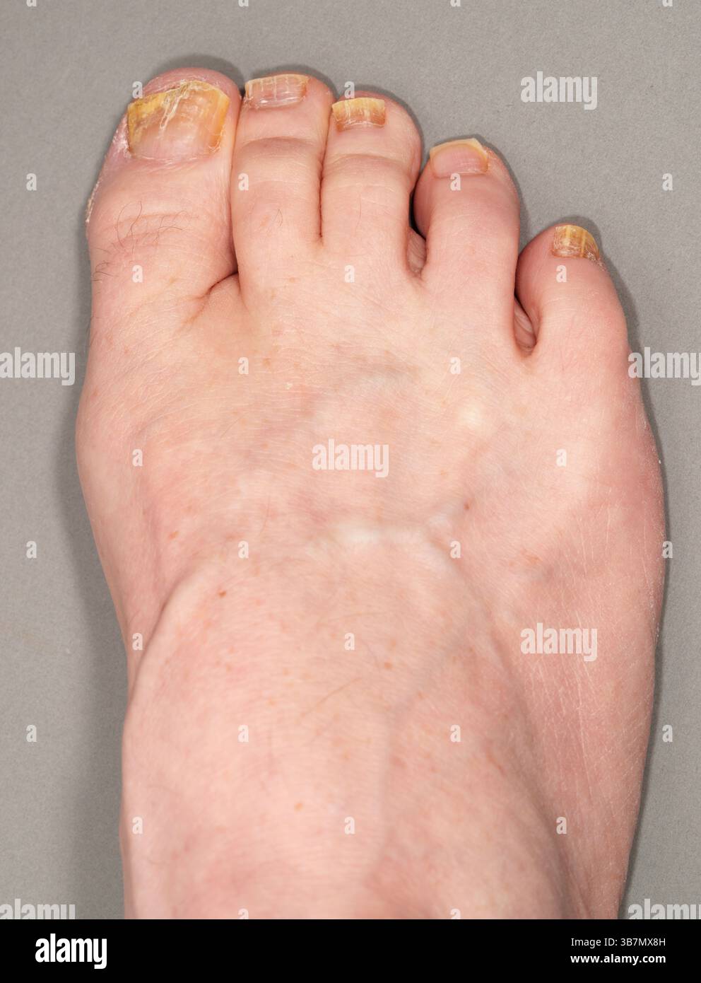 Unsightly dermatophyte, or yellow fungus infesting toenails Stock Photo ...