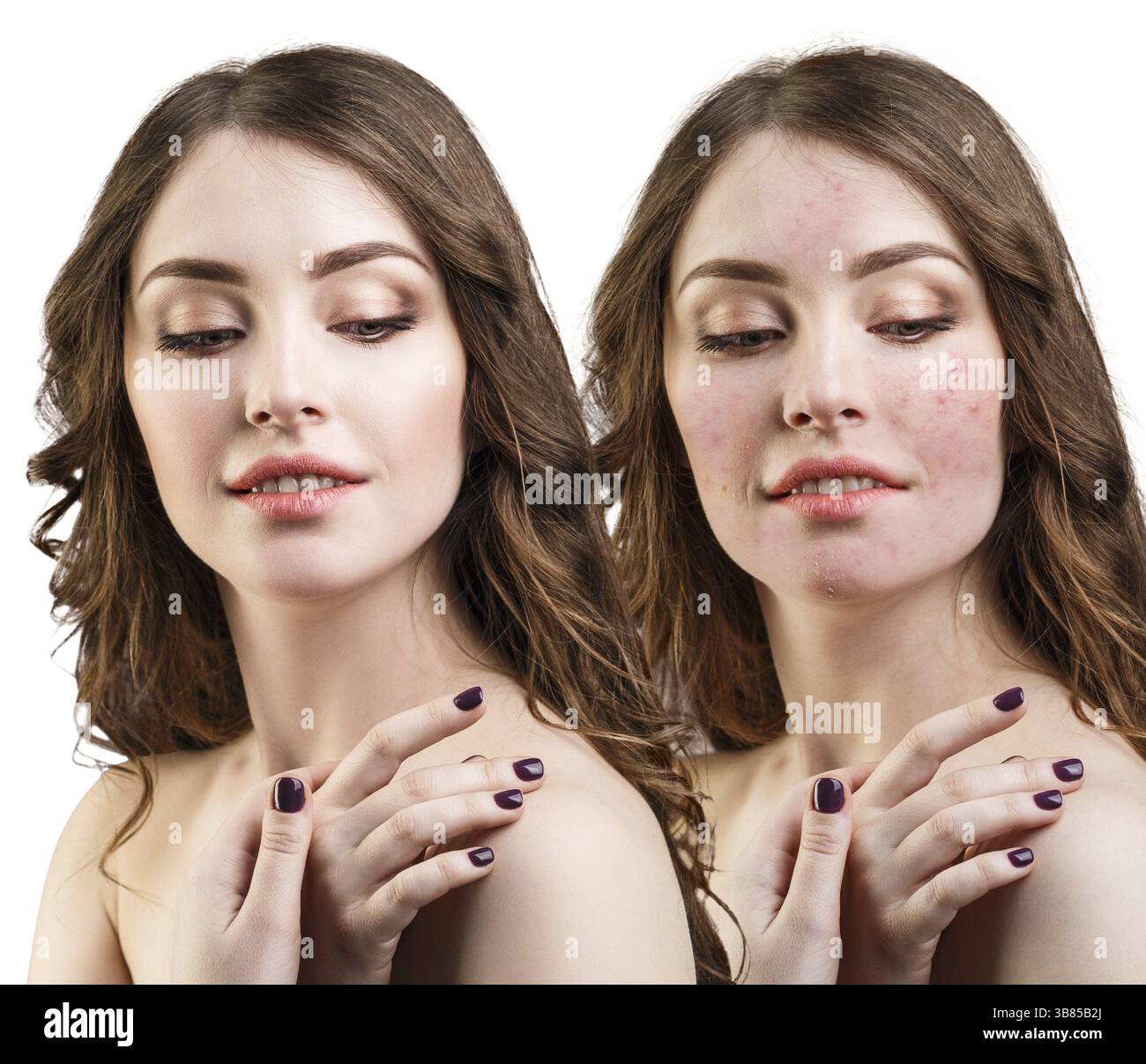 Woman with problem skin on her face before and after treatment over ...