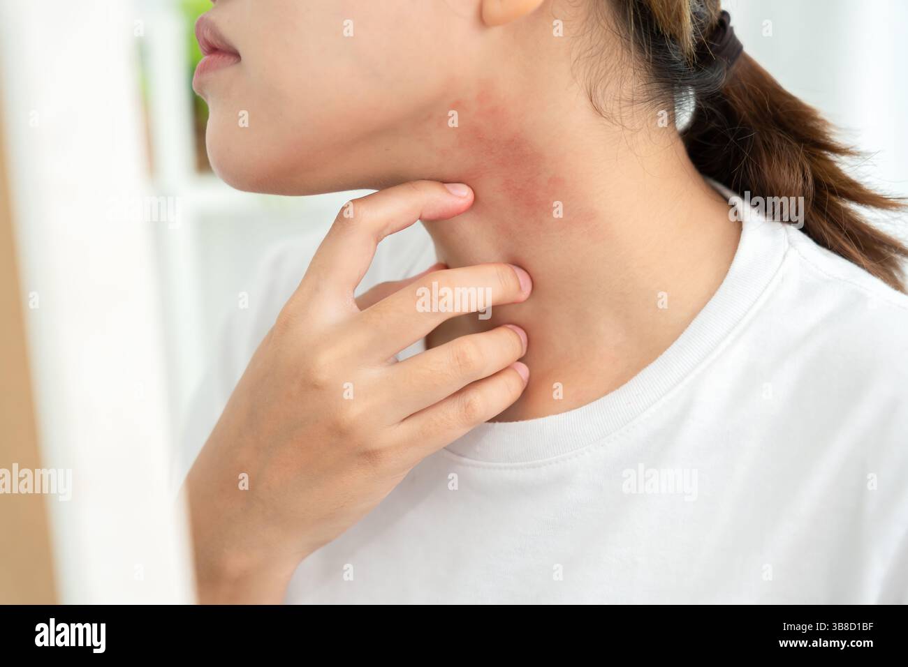 skin problem and beauty. Young woman scratch body has itchy skin from ...
