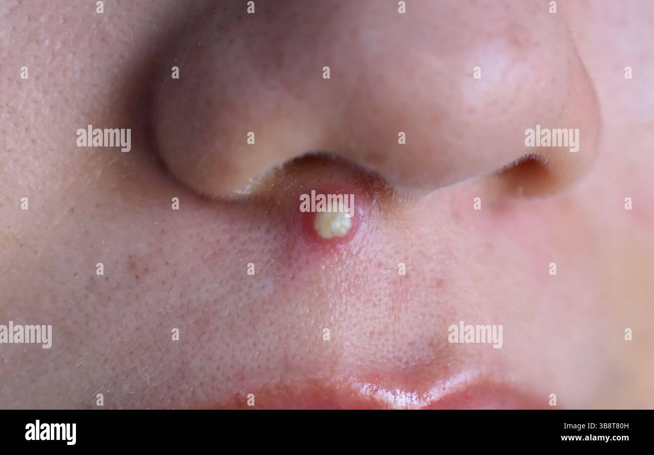 Severe Cystic Acne and Inflammation on the Face Stock Photo - Alamy