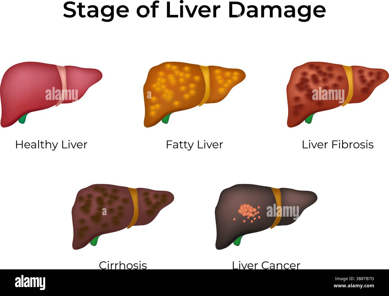 Liver disease stages hi-res stock photography and images - Alamy
