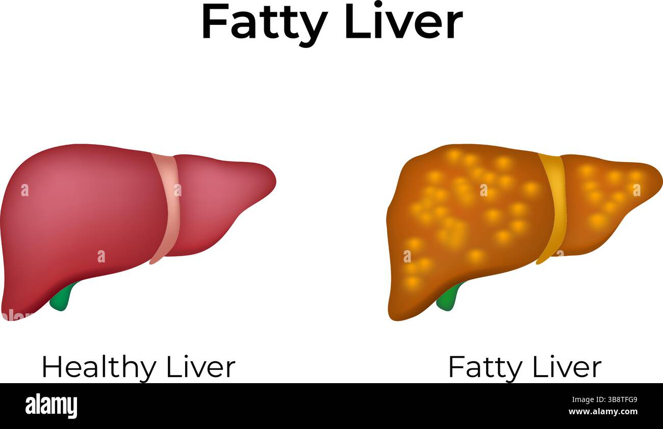 Fatty Liver vs Healthy Liver Design Vector Illustration Stock Vector ...