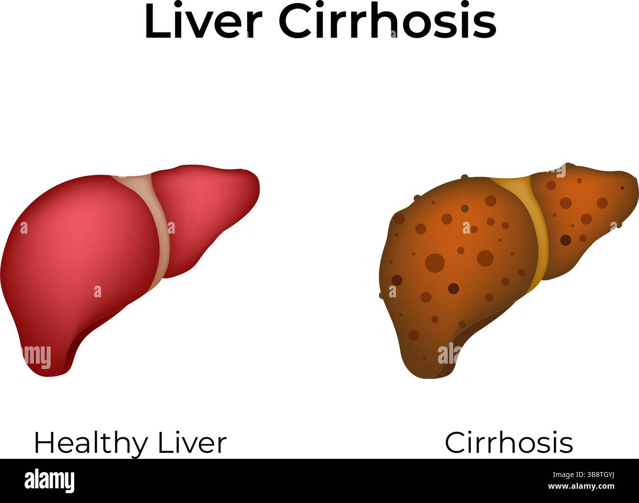 Liver Cirrhosis vs Healthy Liver Design Vector Illustration Stock ...