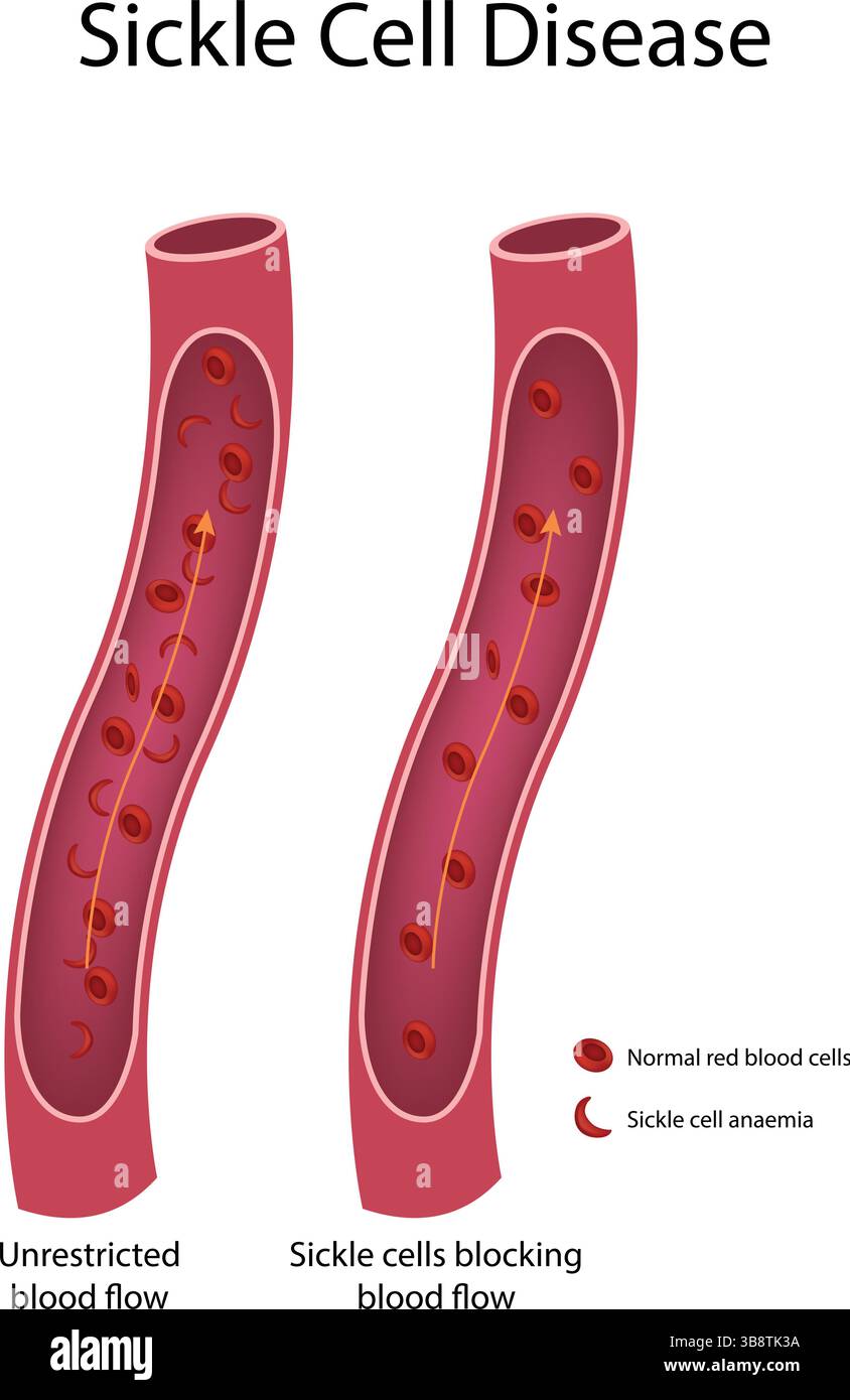 Sickle Cell Disease Normal vs Sickle Cell Anemia Blood Flow Vector ...