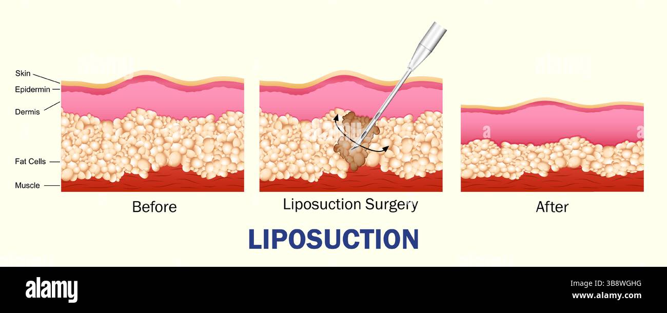 illustration of educational cutout diagram of human skin showing the process of Liposuction ...