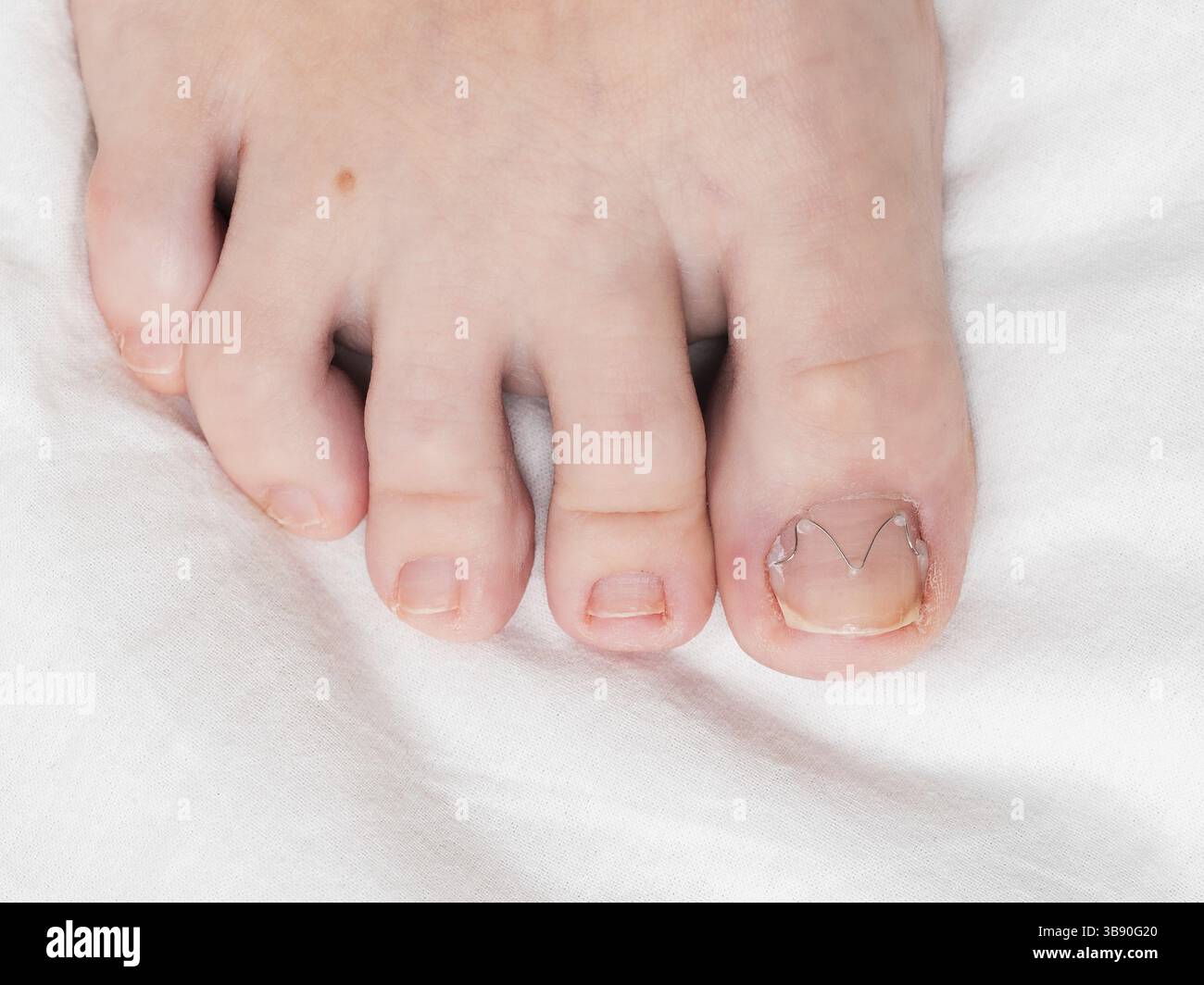 Pedicurist working on the toe nail hi-res stock photography and images ...