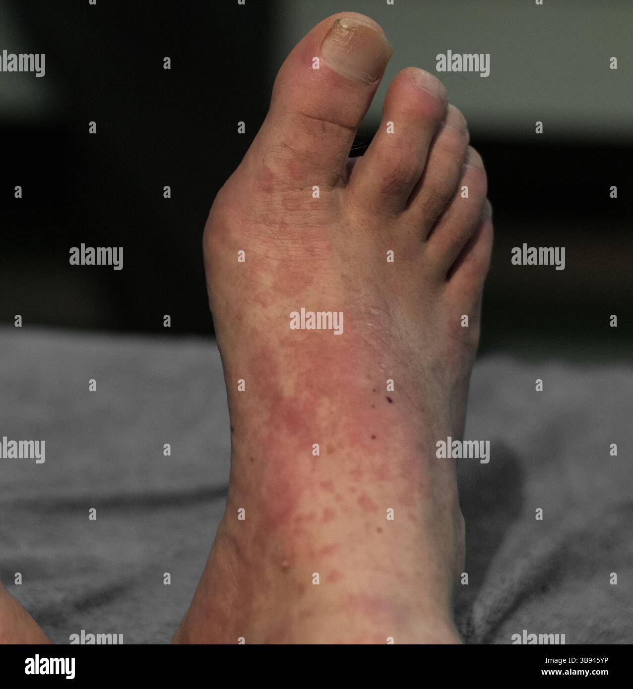 Bumpy foot hi-res stock photography and images - Alamy