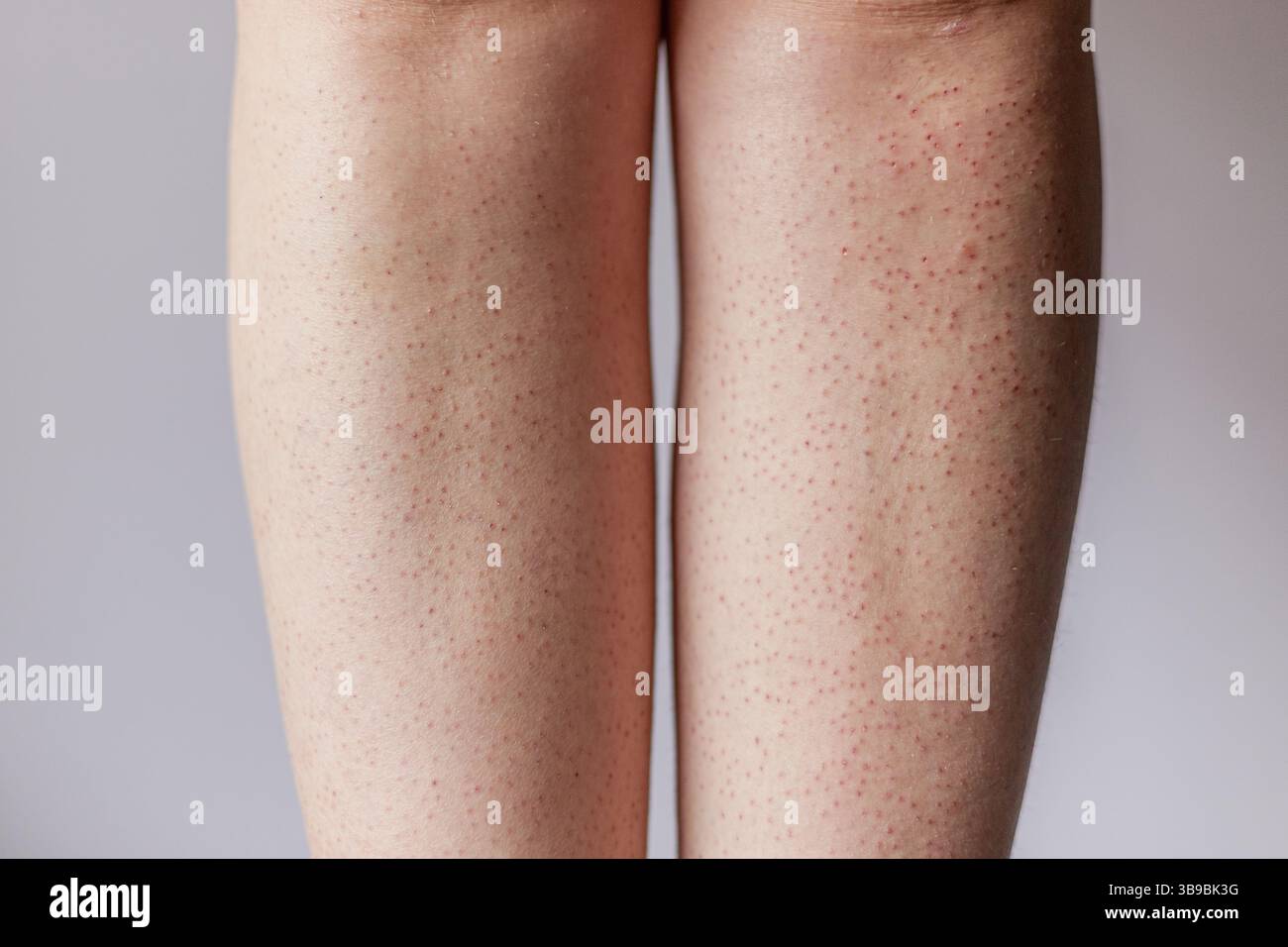 Female legs with red irritation and visible hair after painful ...