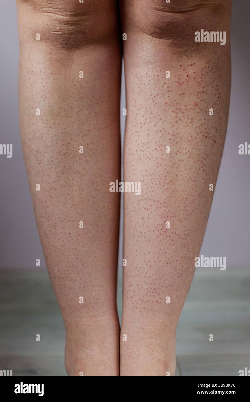 Female legs with red irritation and visible hair after painful ...