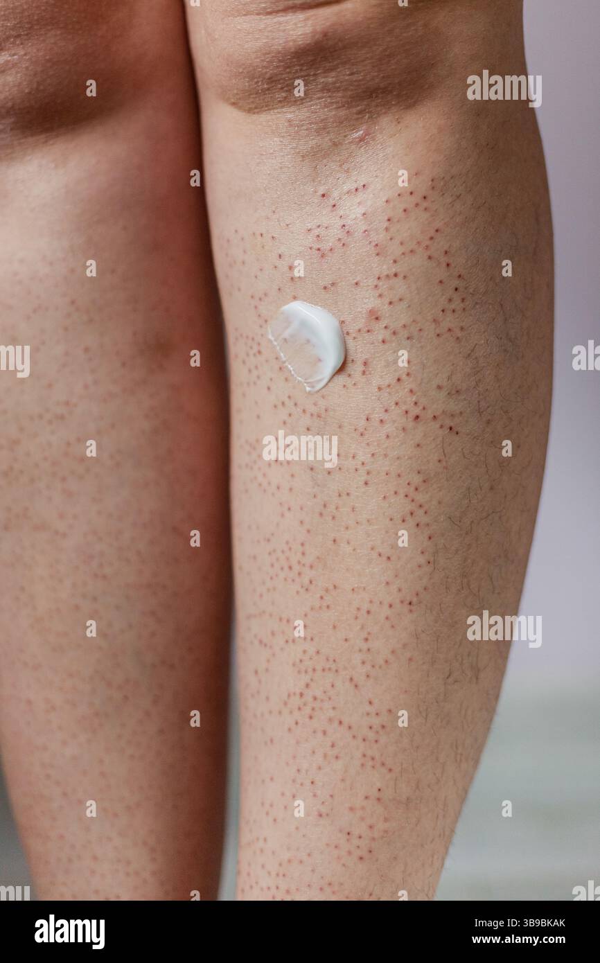 Skin irritation and rash on female leg with dot of cream applied after ...