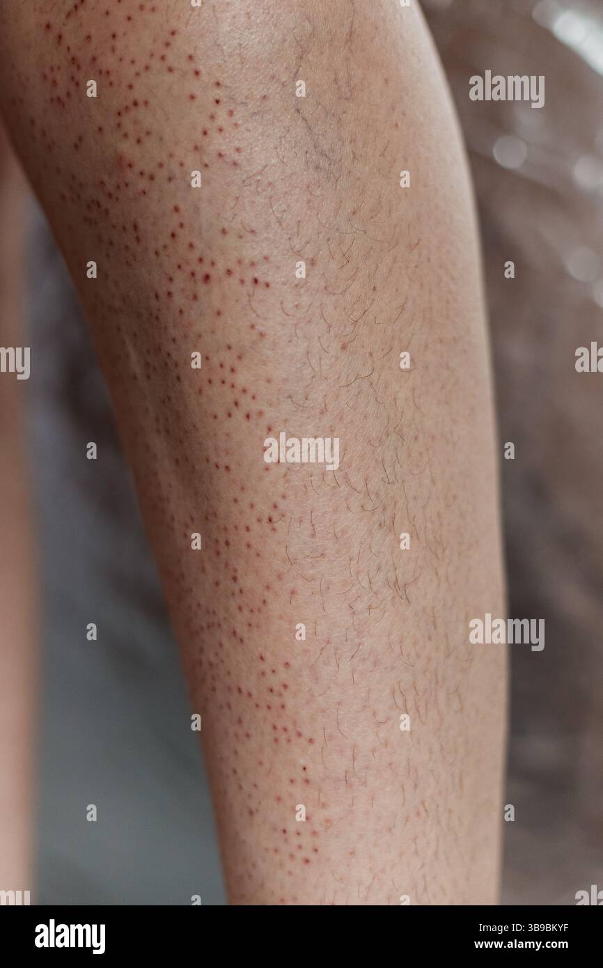 Female legs with red irritation and visible hair after painful ...
