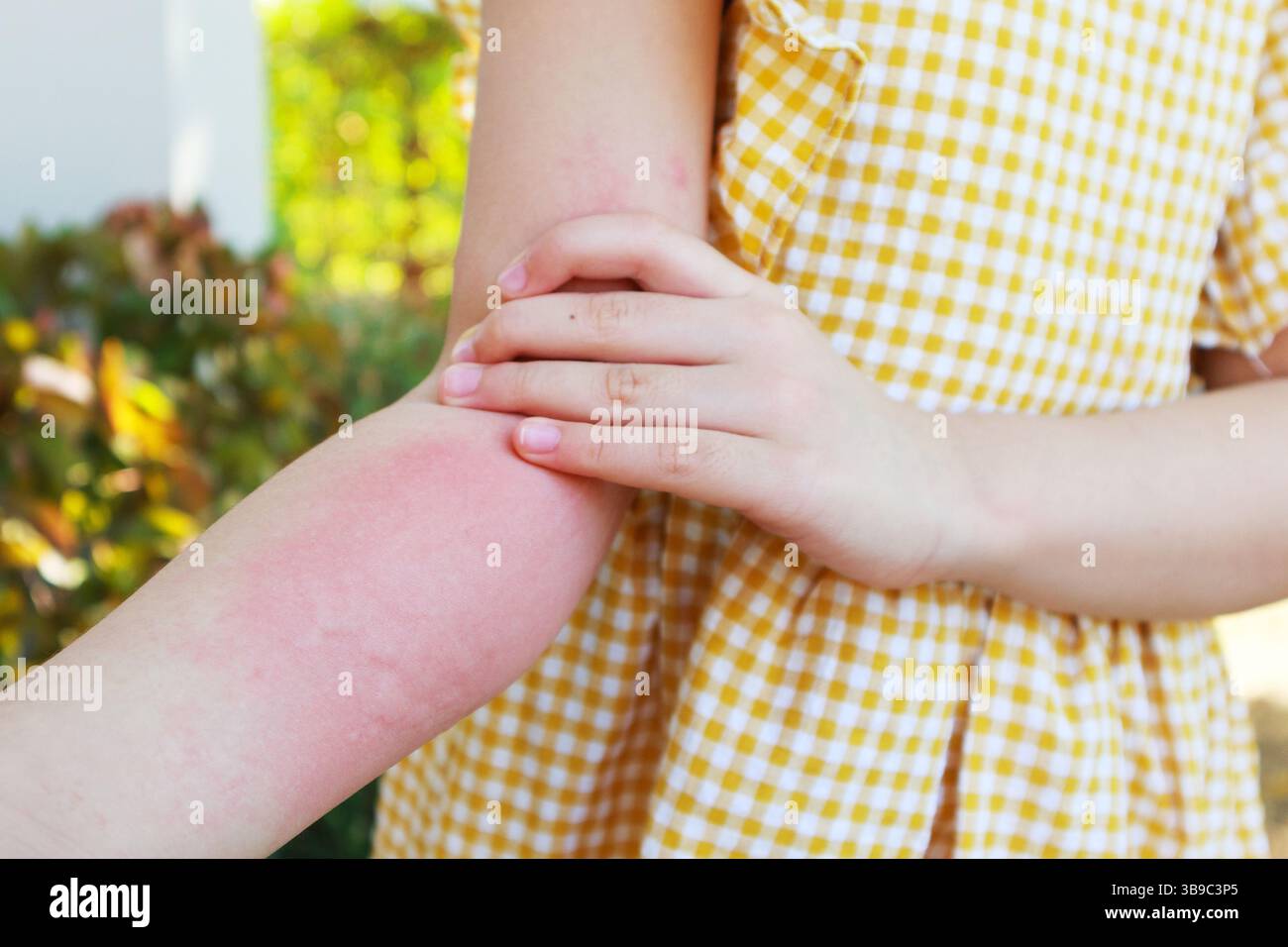 Little girl has skin rash allergy and itchy on her arm Stock Photo - Alamy