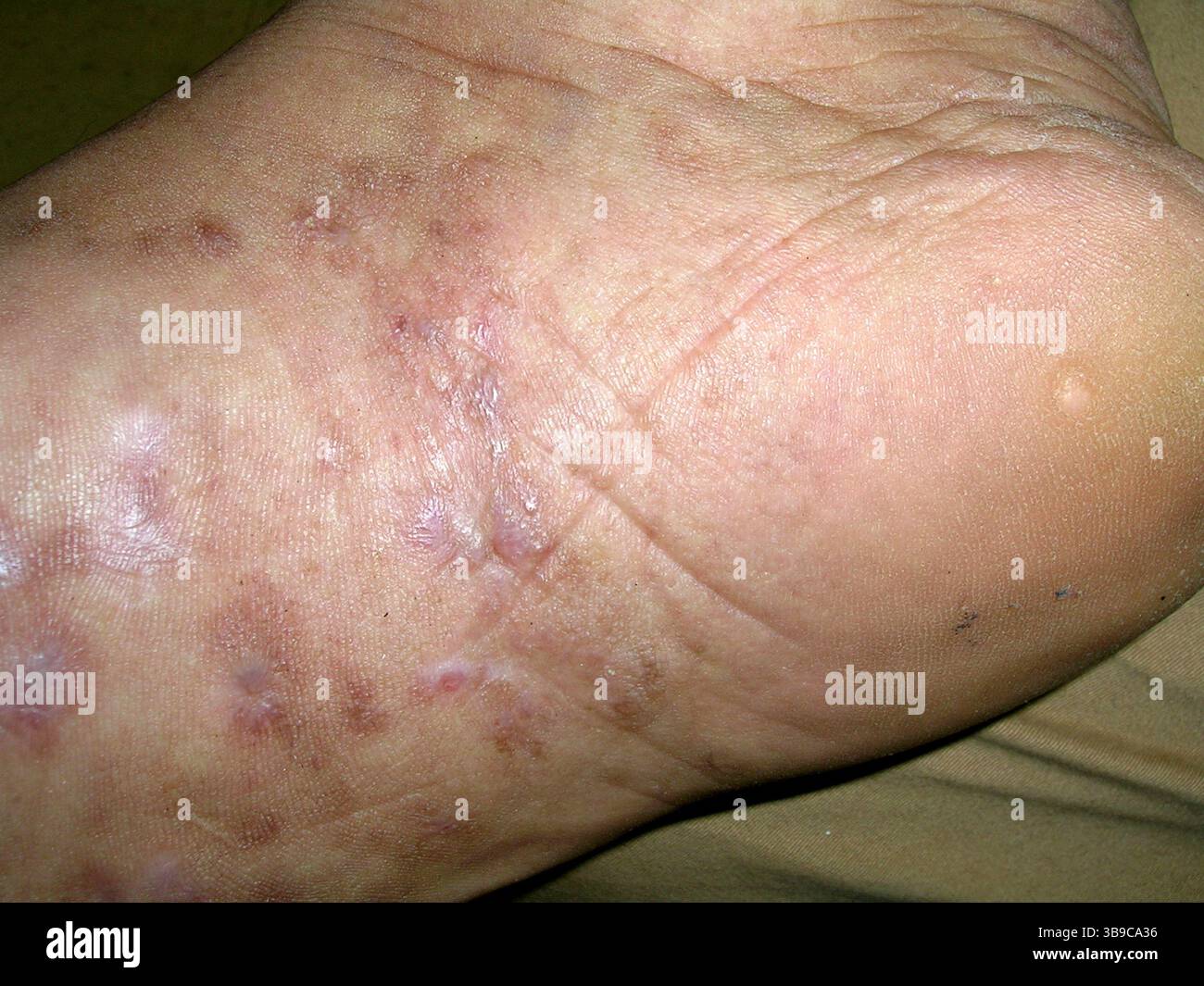 Bullous athlete's foot infection. Athlete's foot, or tinea pedis, is a ...