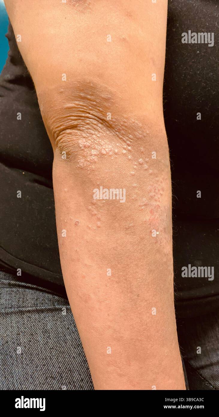 Psoriasis on the arm of an Hispanic female patient that is improving ...