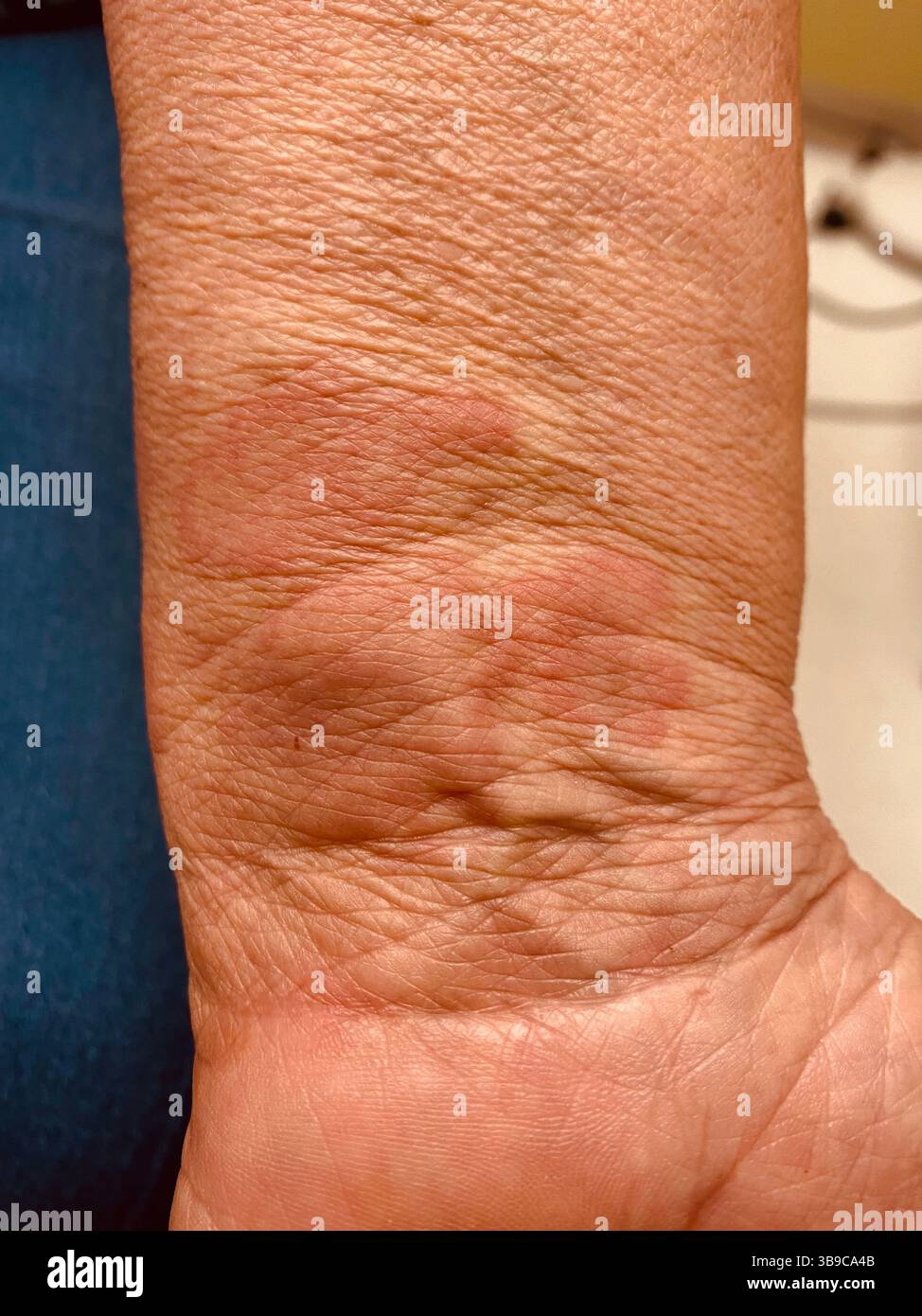 Rash on the wrist of a 69 year old Hispanic female patient with ...