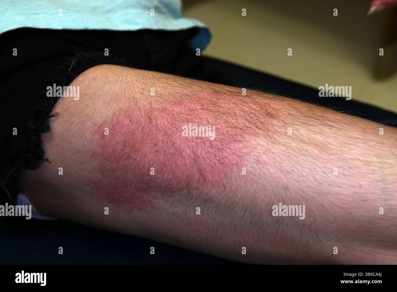 Rash on the leg of an 11 year old female Hispanic patient with ...