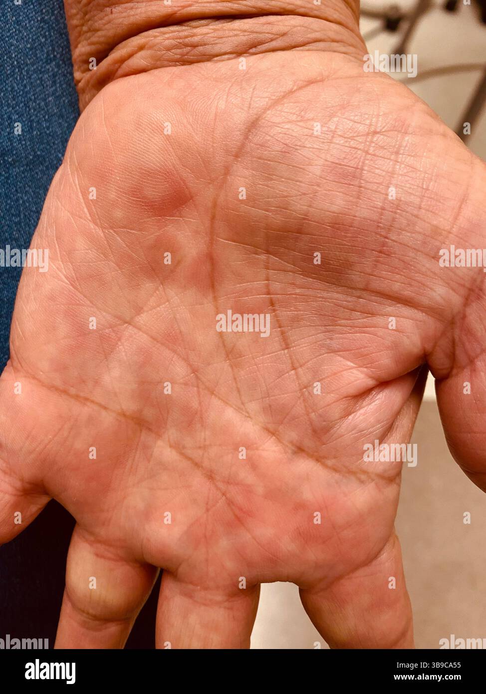 Rash on the hand of a 69 year old Hispanic female patient with ...