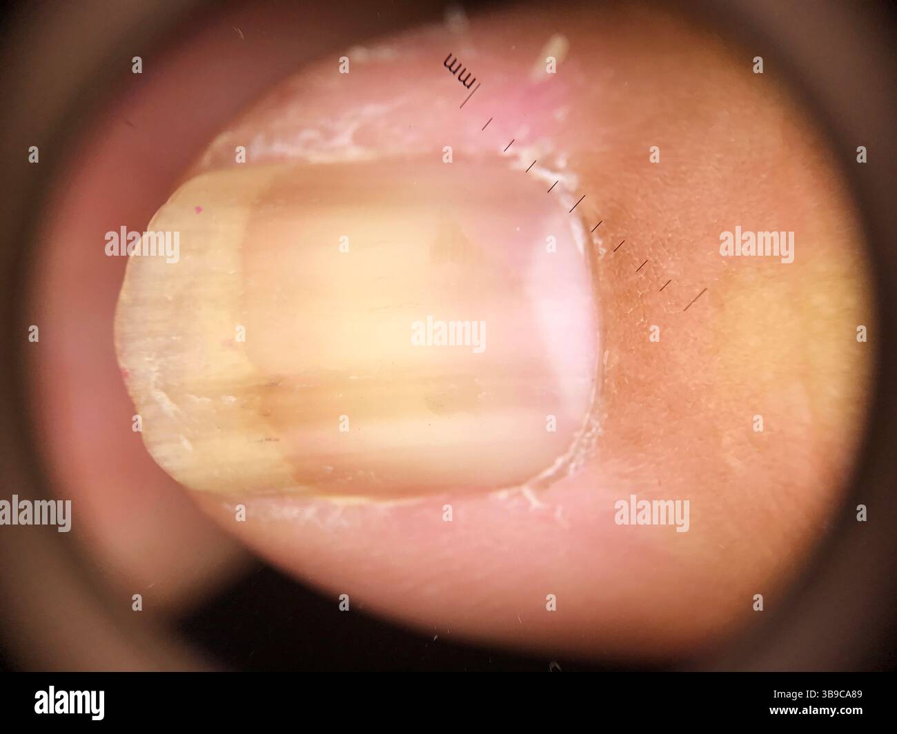 Dermatoscope image of a fingernail with longitudinal (lengthwise ...