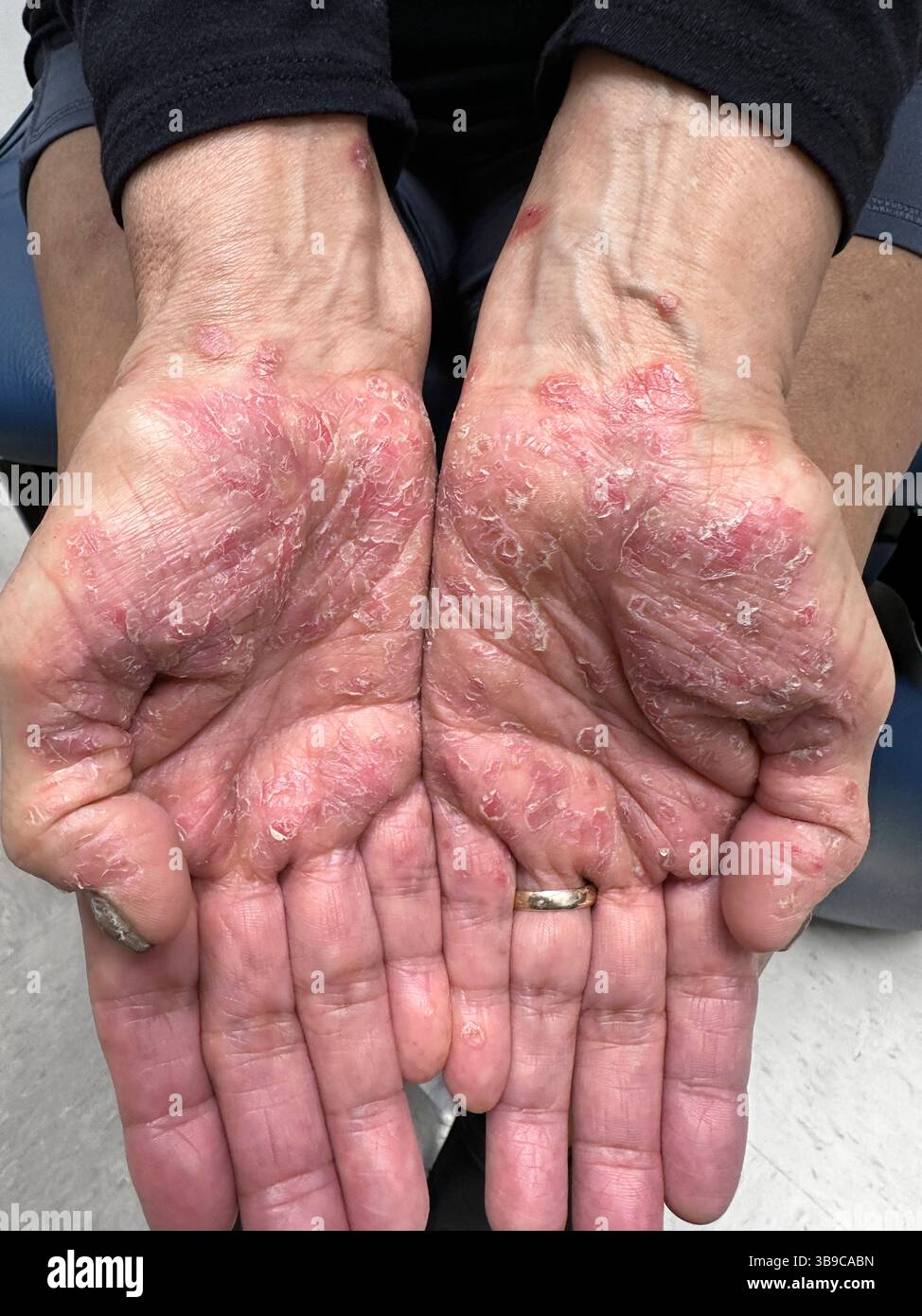 Palmoplantar psoriasis on the hands of a Hispanic female patient ...