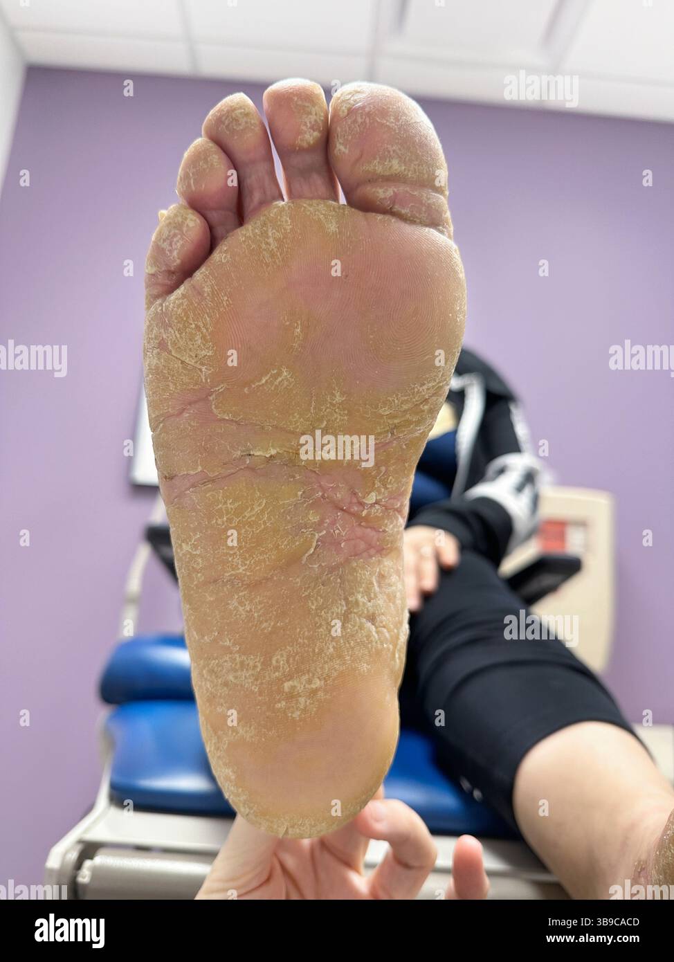 Palmoplantar psoriasis on the foot of a Hispanic female patient ...