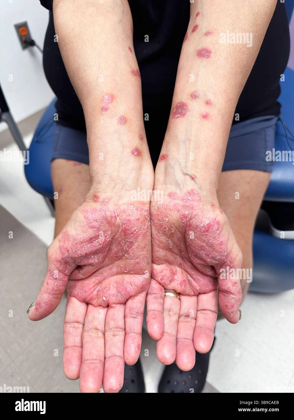 Palmoplantar psoriasis on the hands of a Hispanic female patient ...