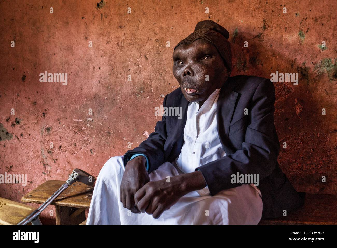 Godfrey Bagume, Sebabi, Fibrodysplasia Ossificans Progressiva (FOP ...