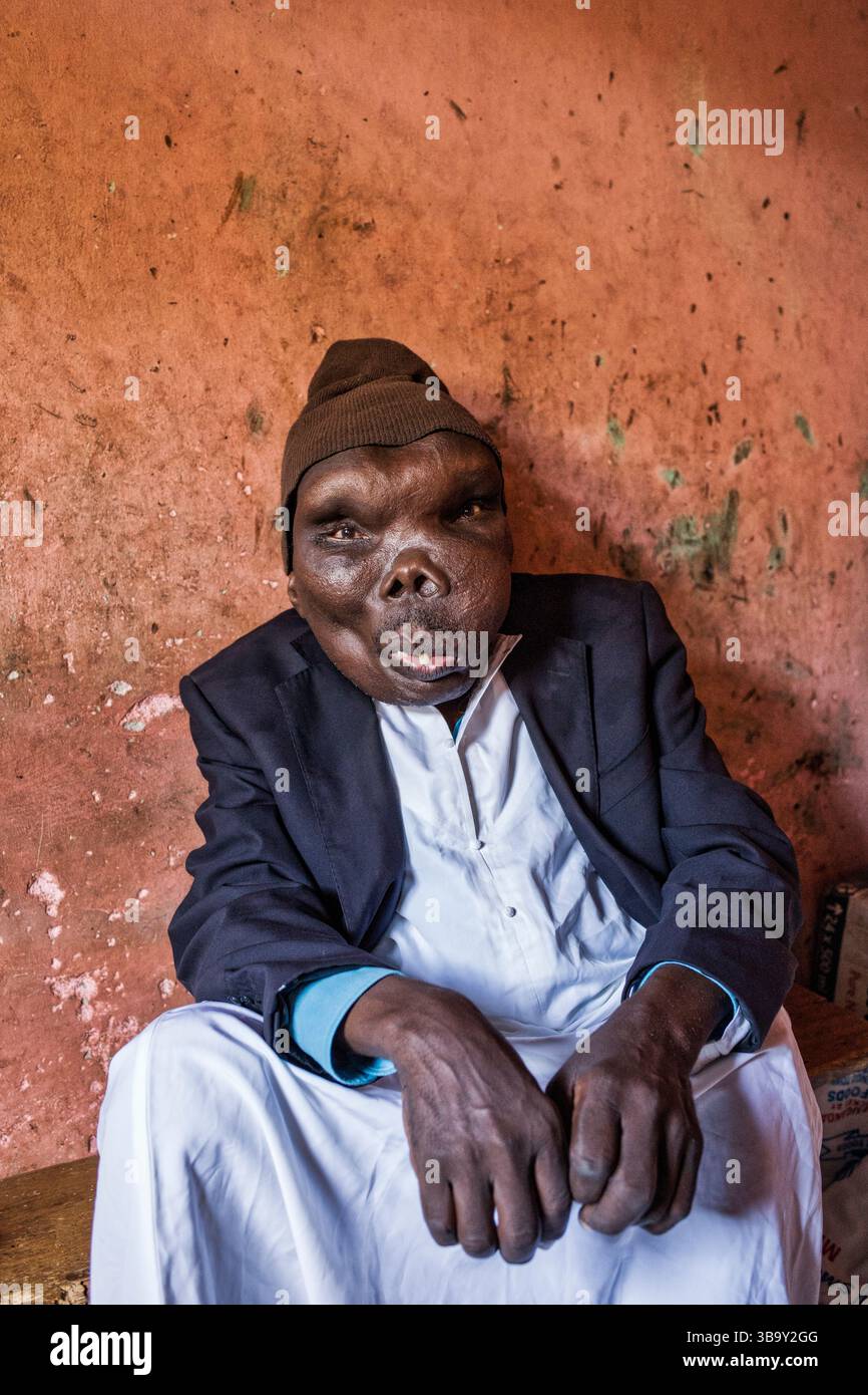 Godfrey Bagume, Sebabi, Fibrodysplasia Ossificans Progressiva (FOP ...