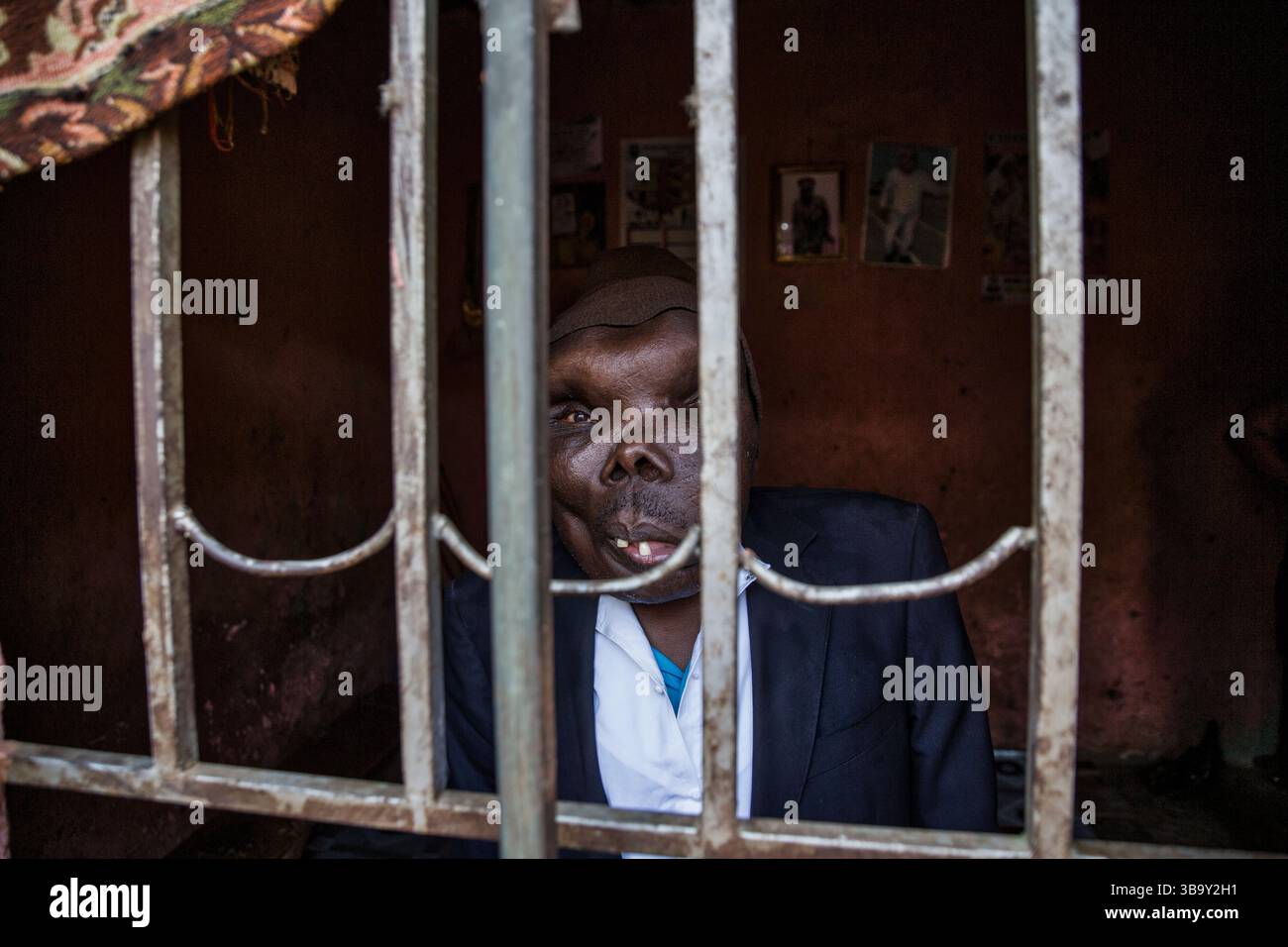 Godfrey Bagume, Sebabi, Fibrodysplasia Ossificans Progressiva (FOP ...
