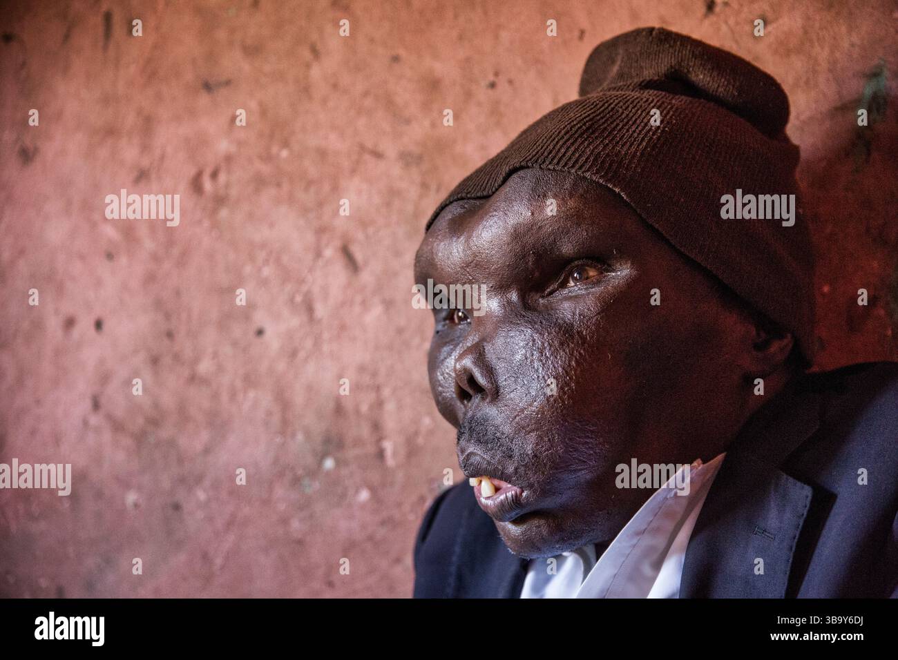 Godfrey Bagume, Sebabi, Fibrodysplasia Ossificans Progressiva (FOP ...