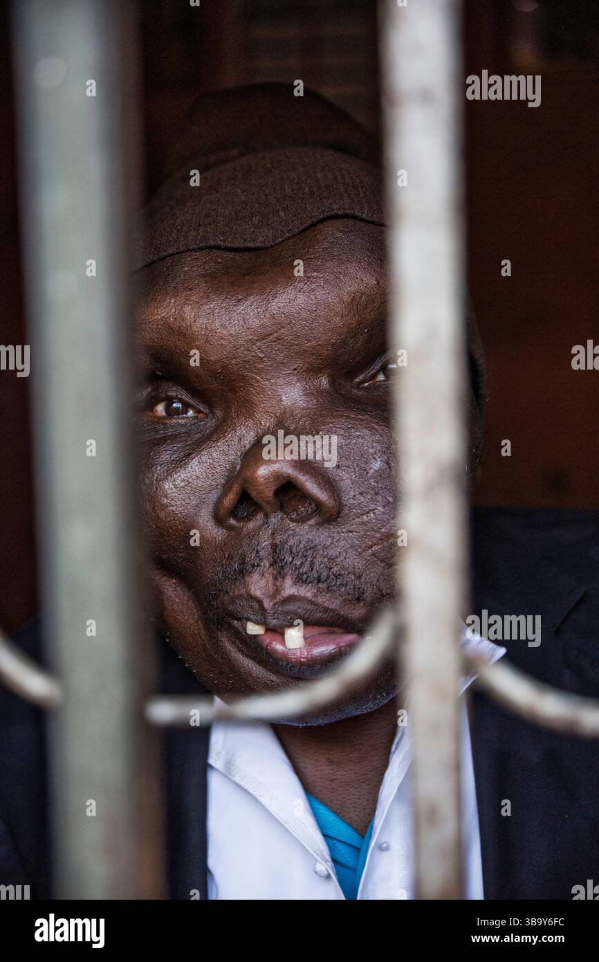 Godfrey Bagume, Sebabi, Fibrodysplasia Ossificans Progressiva (FOP ...