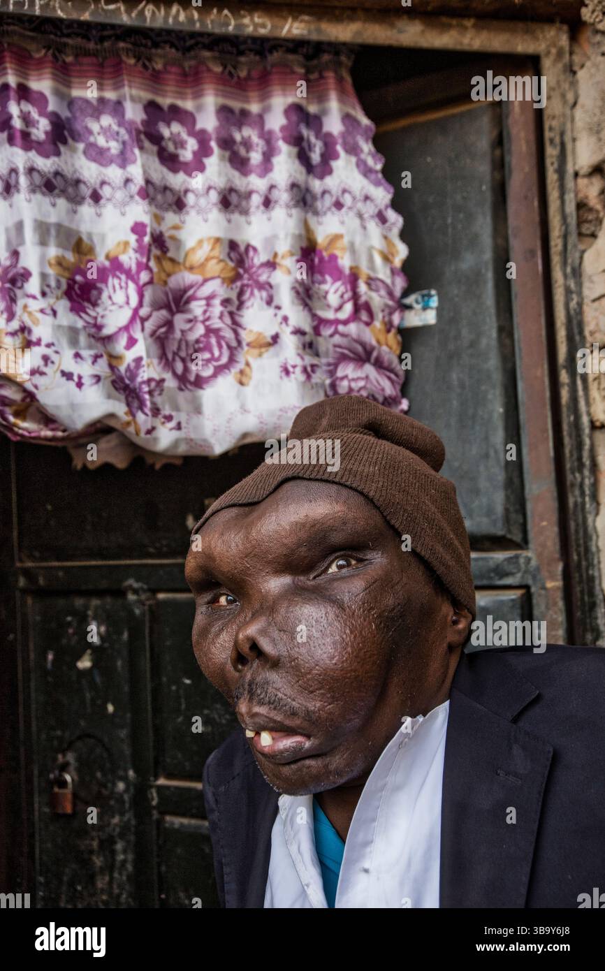 Godfrey Bagume, Sebabi, Fibrodysplasia Ossificans Progressiva (FOP ...