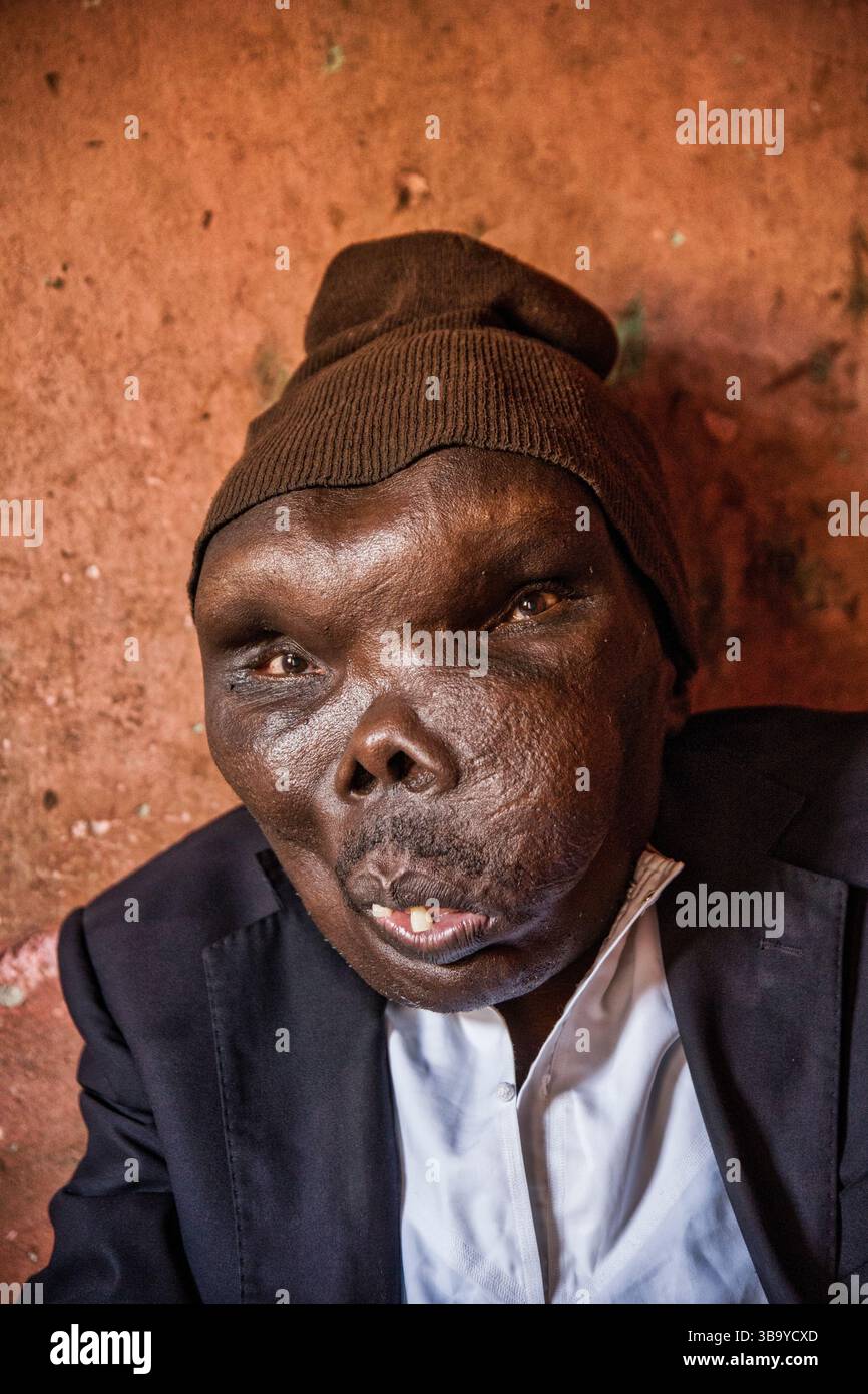 Godfrey Bagume, Sebabi, Fibrodysplasia Ossificans Progressiva (FOP ...