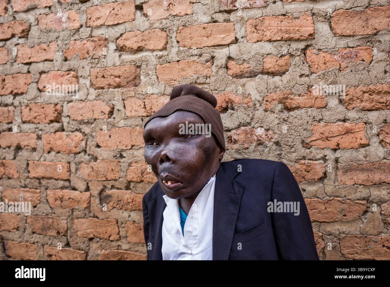 Godfrey Bagume, Sebabi, Fibrodysplasia Ossificans Progressiva (FOP ...