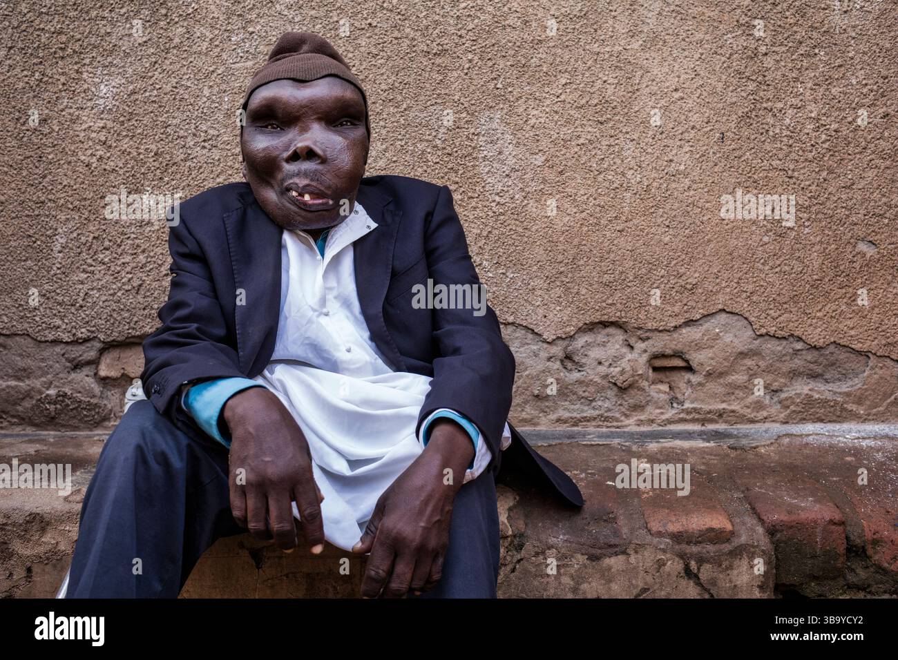 Godfrey Bagume, Sebabi, Fibrodysplasia Ossificans Progressiva (FOP ...