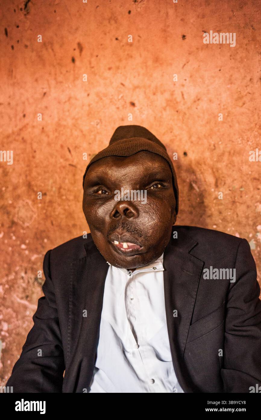 Godfrey Bagume, Sebabi, Fibrodysplasia Ossificans Progressiva (FOP ...