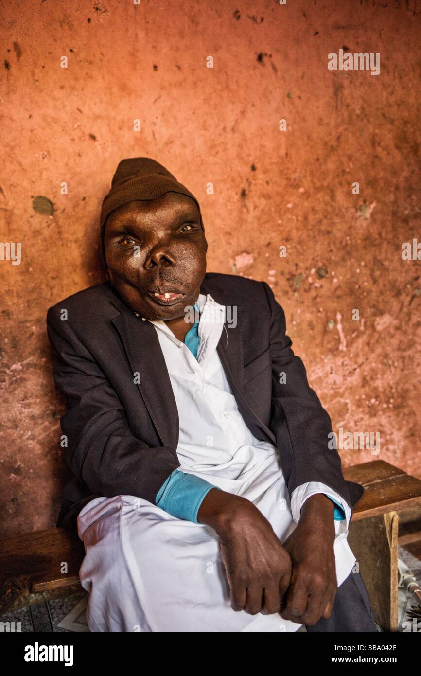 Godfrey Bagume, Sebabi, Fibrodysplasia Ossificans Progressiva (FOP ...