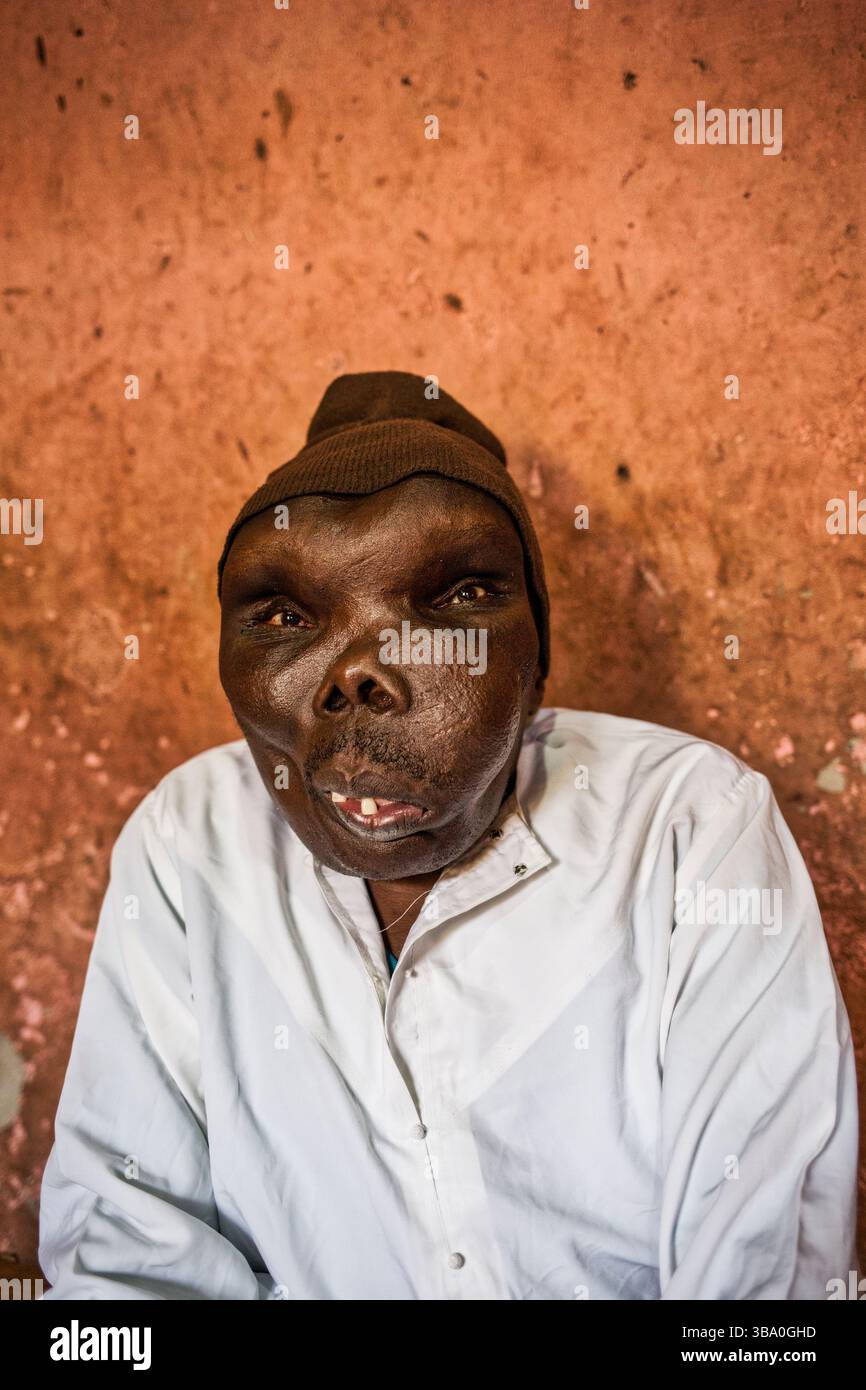 Godfrey Bagume, Sebabi, Fibrodysplasia Ossificans Progressiva (FOP ...