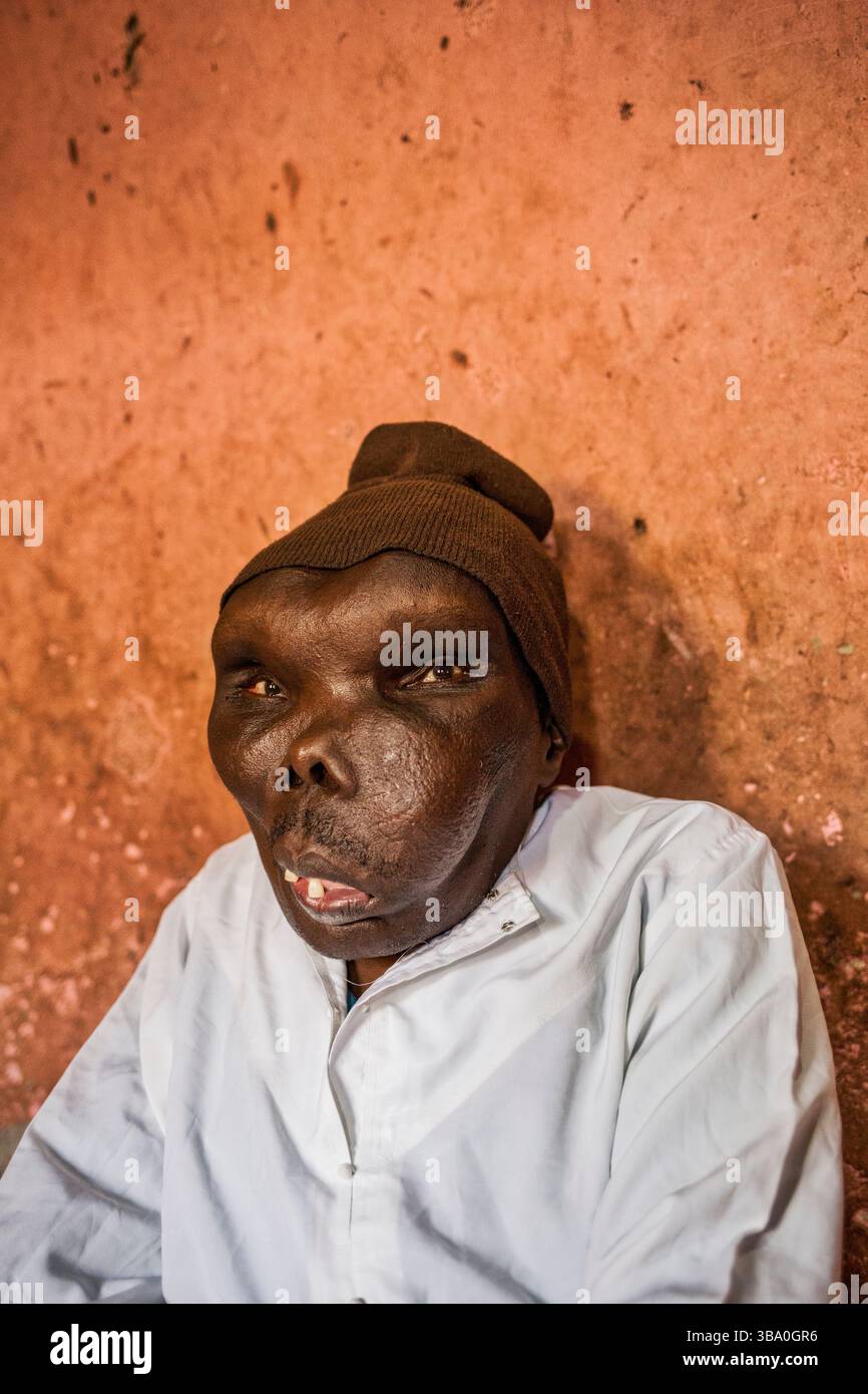 Godfrey Bagume, Sebabi, Fibrodysplasia Ossificans Progressiva (FOP ...