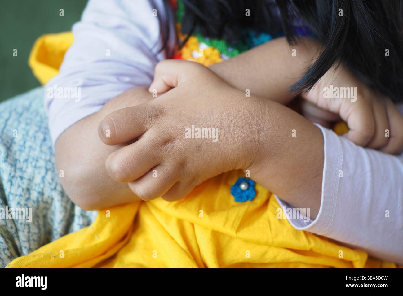 Child suffering itching skin on her arm Stock Photo - Alamy