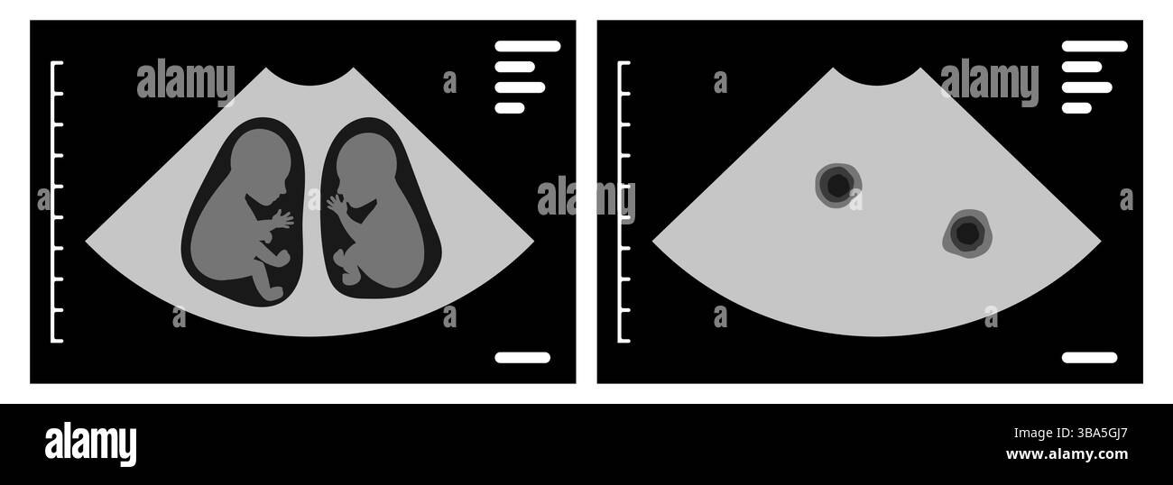 Ultrasound scan showing dichorionic diamniotic twins during pregnancy ...
