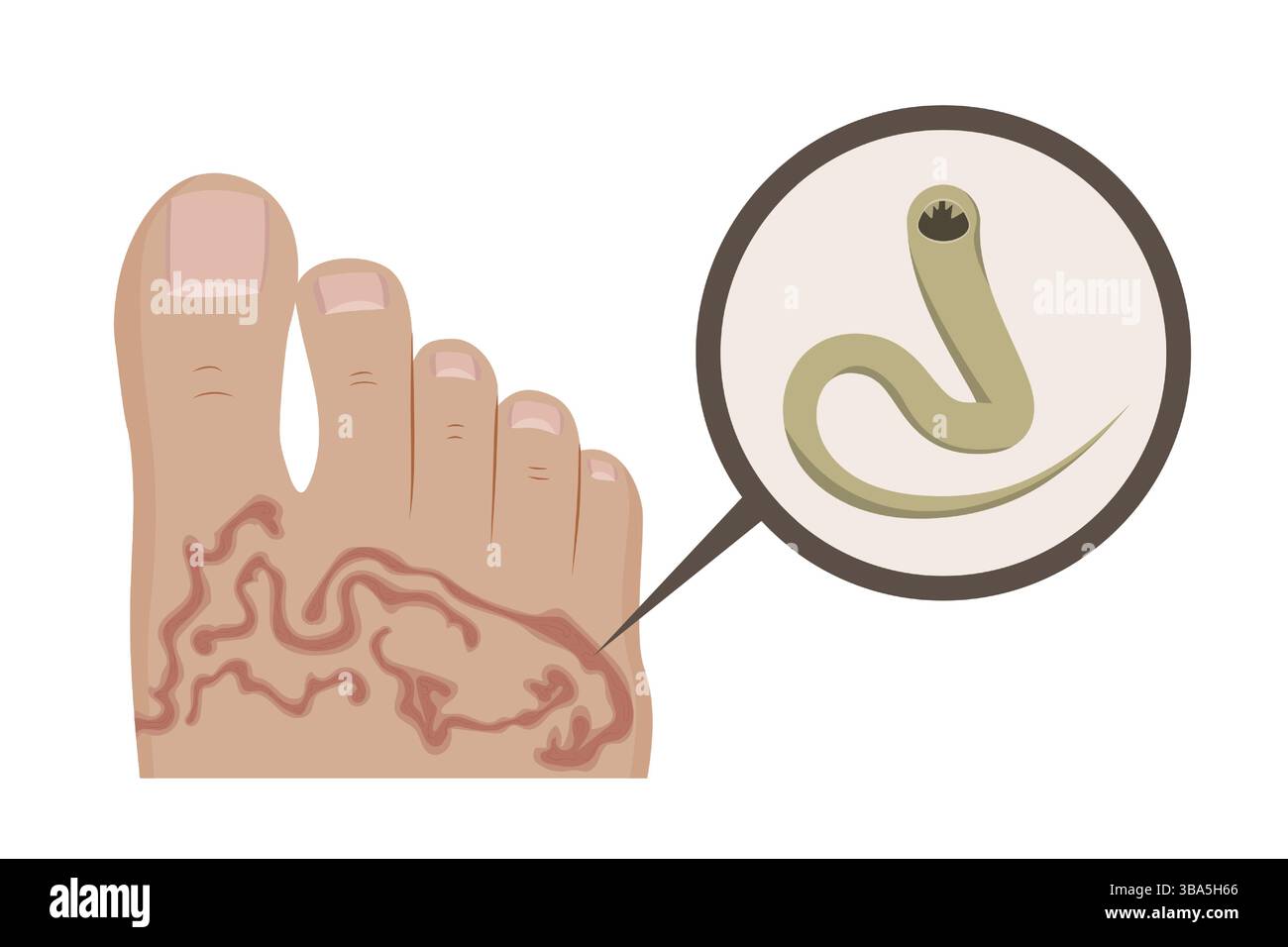 Hookworm skin hi-res stock photography and images - Alamy