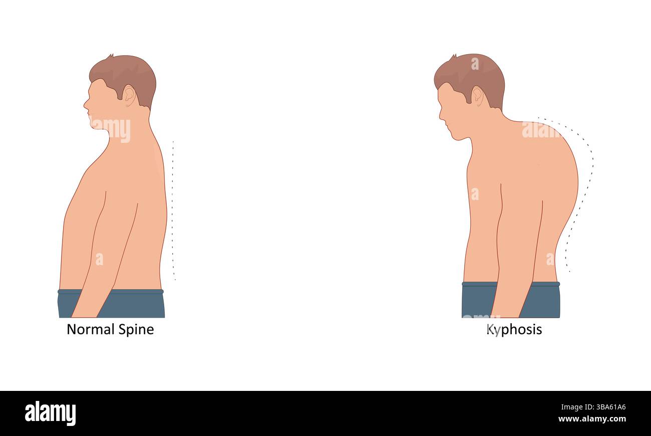Kyphosis vector illustration Stock Vector Image & Art - Alamy