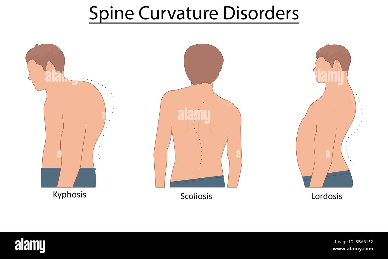 Neuromuscular pathology Stock Vector Images - Alamy