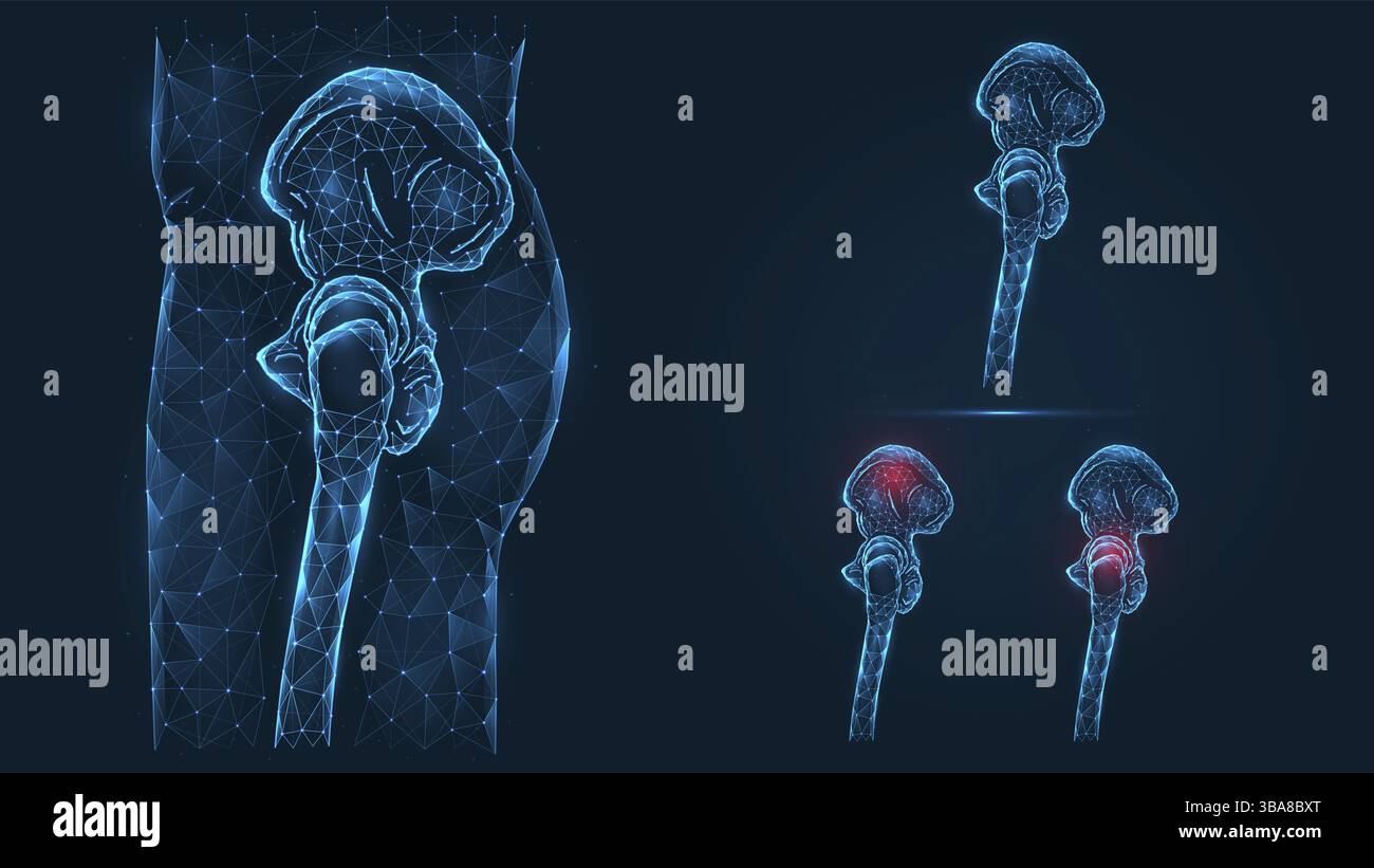 Polygonal illustration of human pelvic and hip bones side view. Disease ...