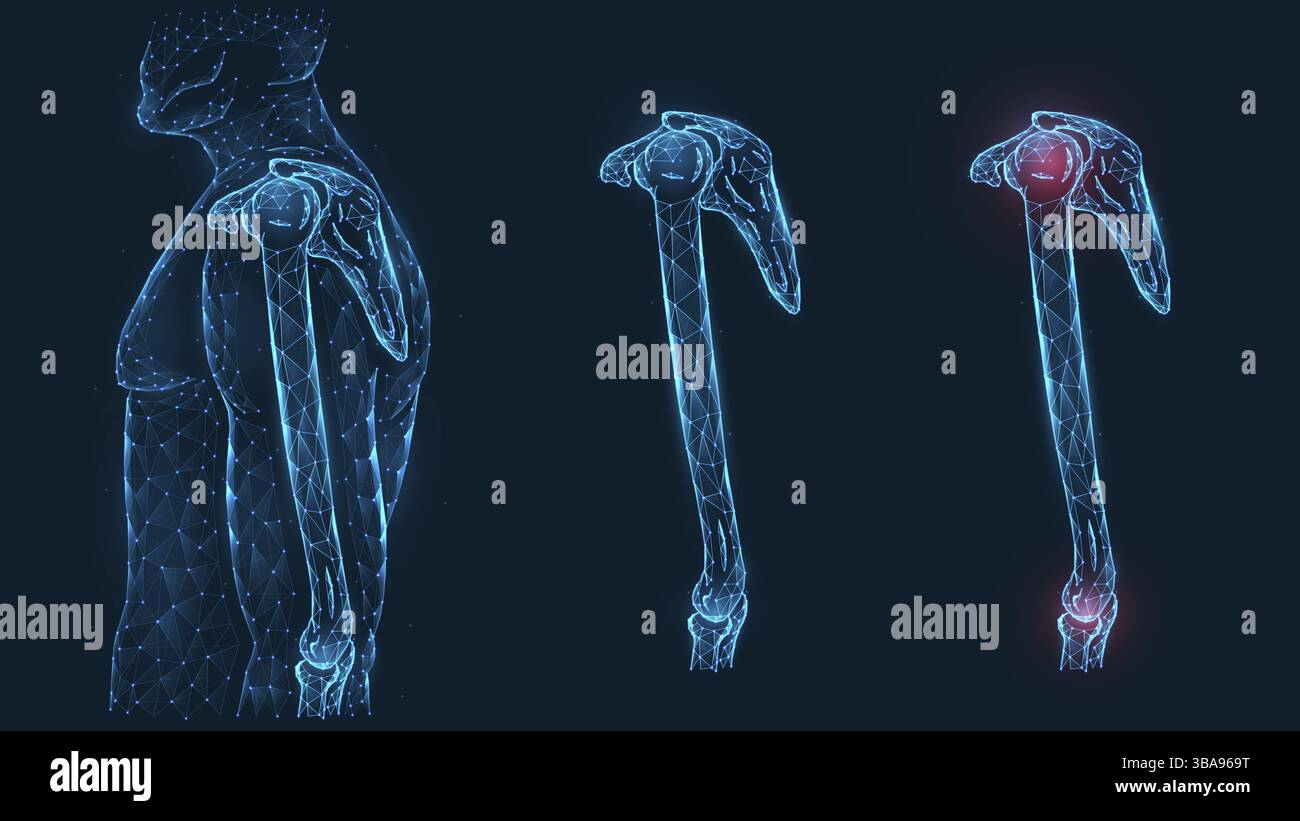 Human anatomical model. Pain, injury and inflammation of the shoulder ...