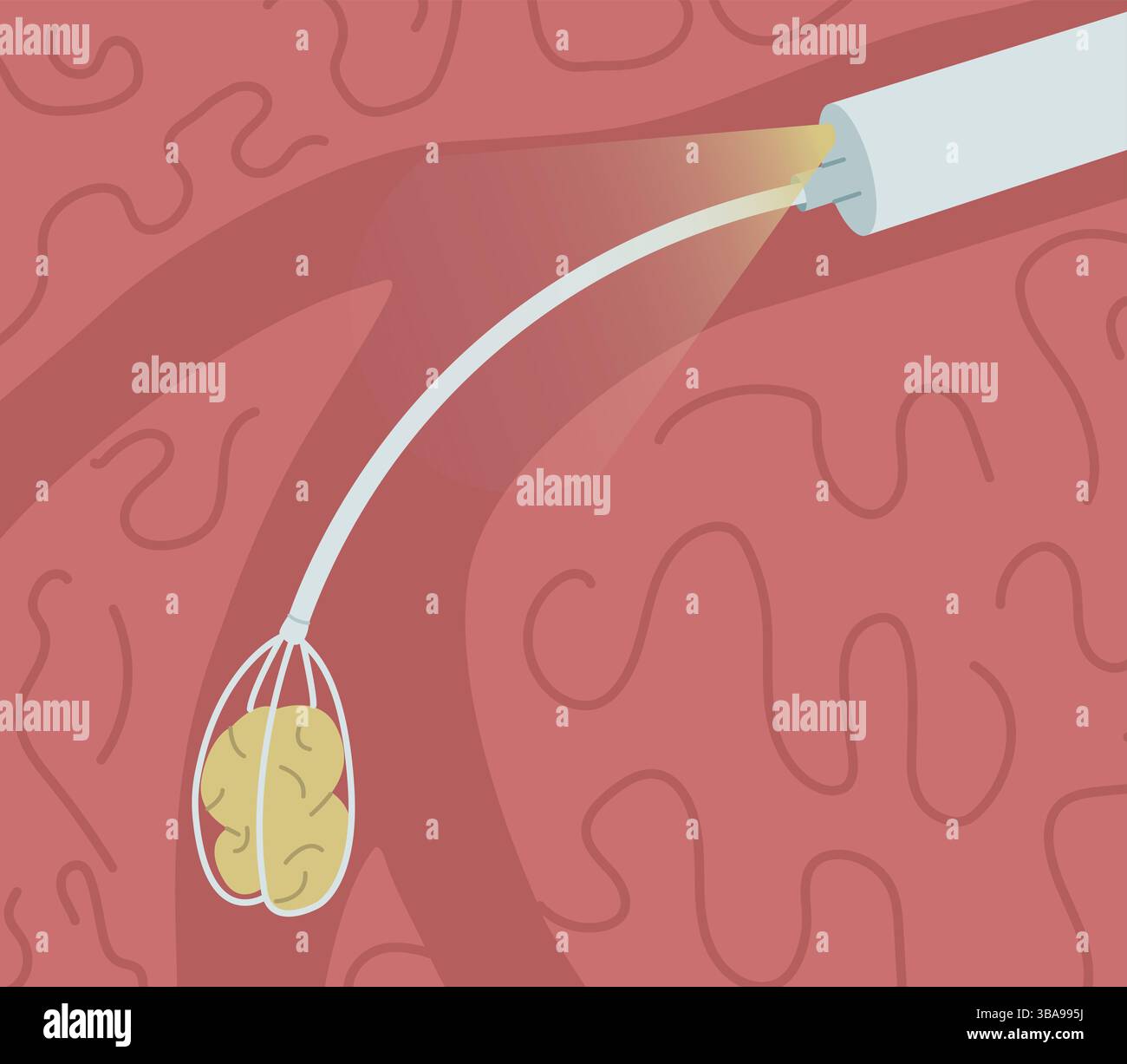 Removal of a stone from the salivary gland duct. Sialendoscopy vector ...